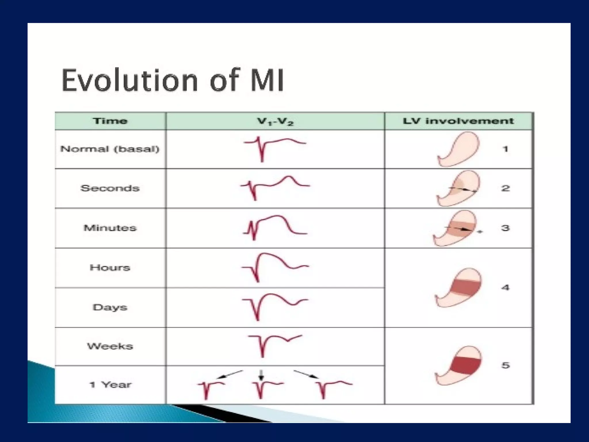 Ekg myocardial ischemia & Infarction | PPT