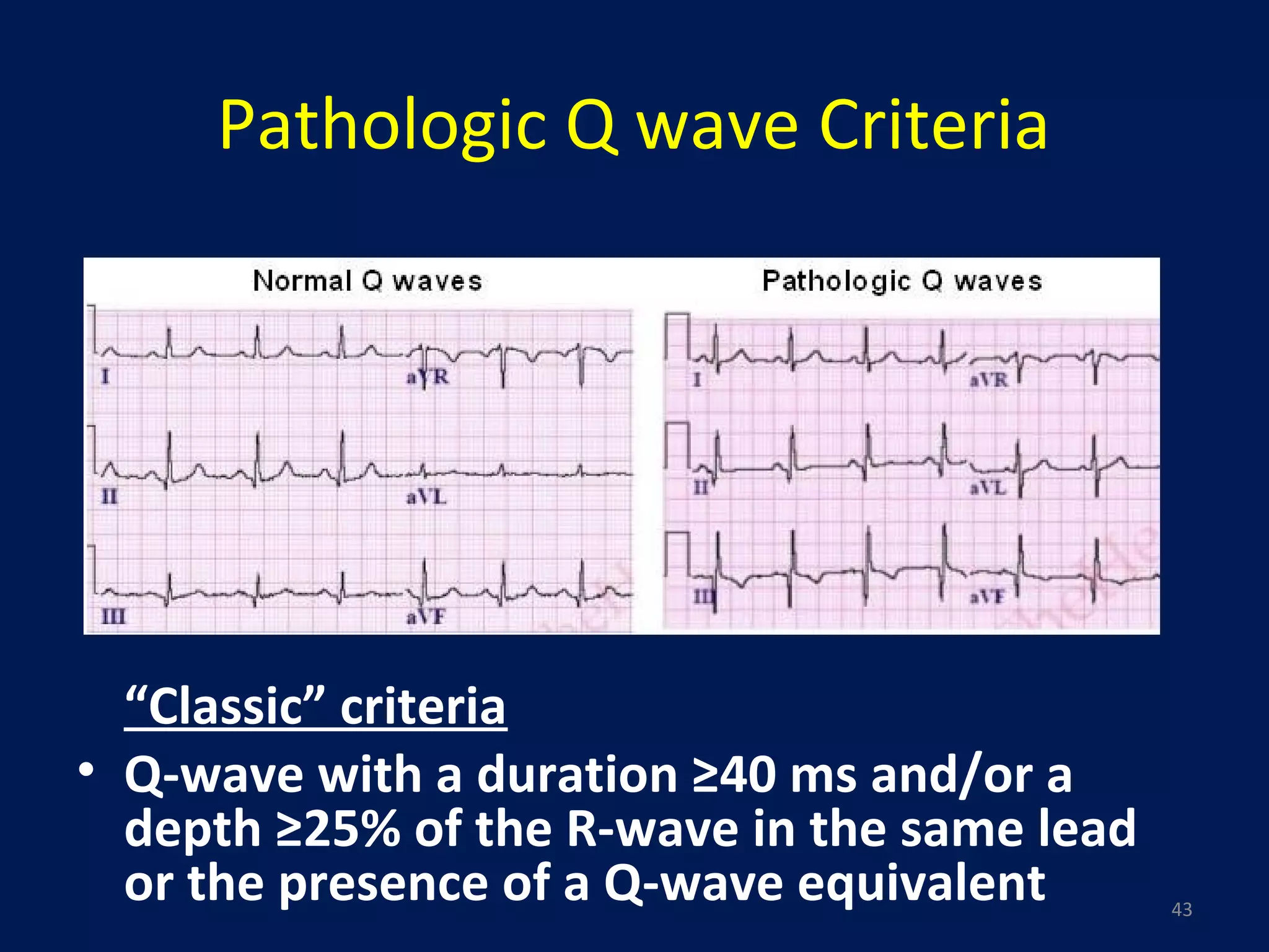 Ekg myocardial ischemia & Infarction | PPT