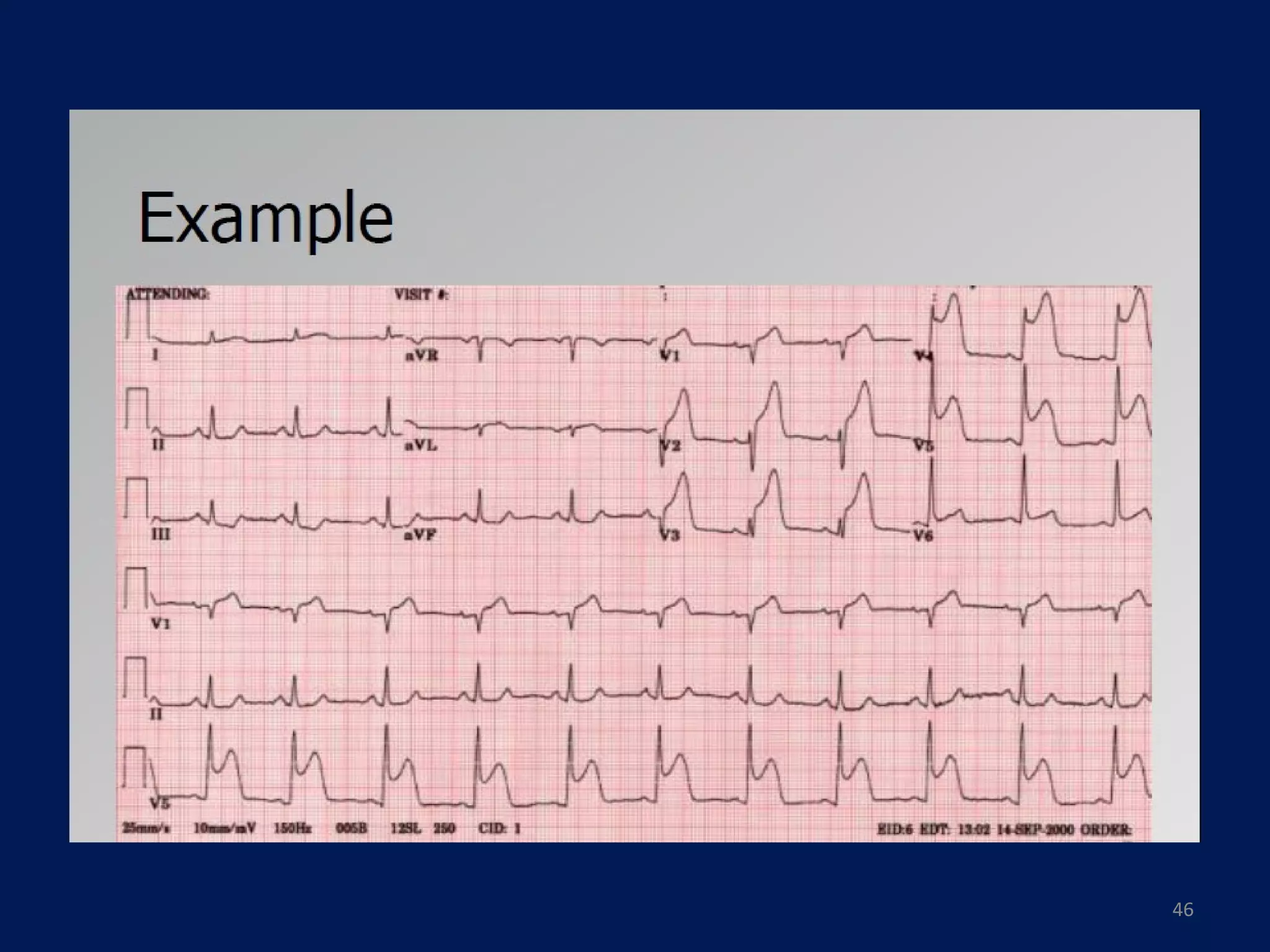 Ekg myocardial ischemia & Infarction | PPT | Free Download
