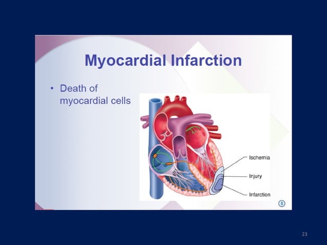 Ekg myocardial ischemia & Infarction | PPT