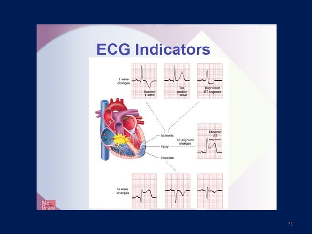 Ekg myocardial ischemia & Infarction | PPT