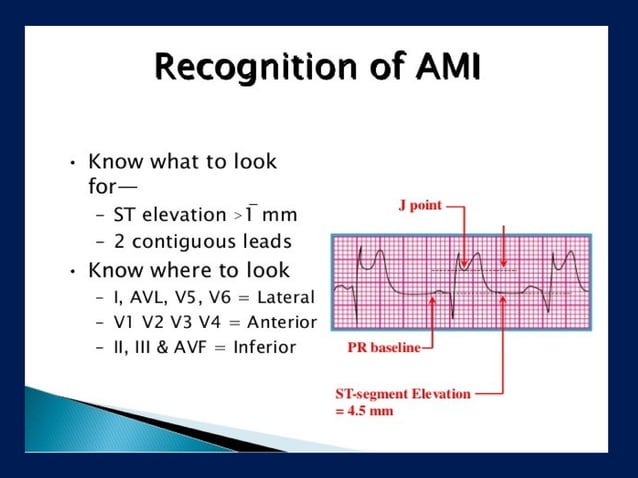 Ekg myocardial ischemia & Infarction | PPT