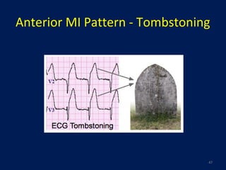 Ekg myocardial ischemia & Infarction | PPT