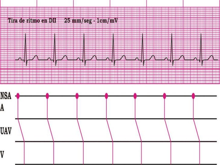 Ekg normal
