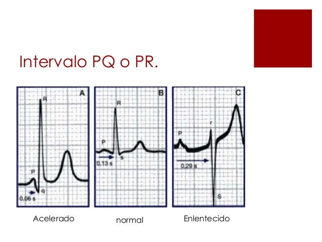 Ekg normal