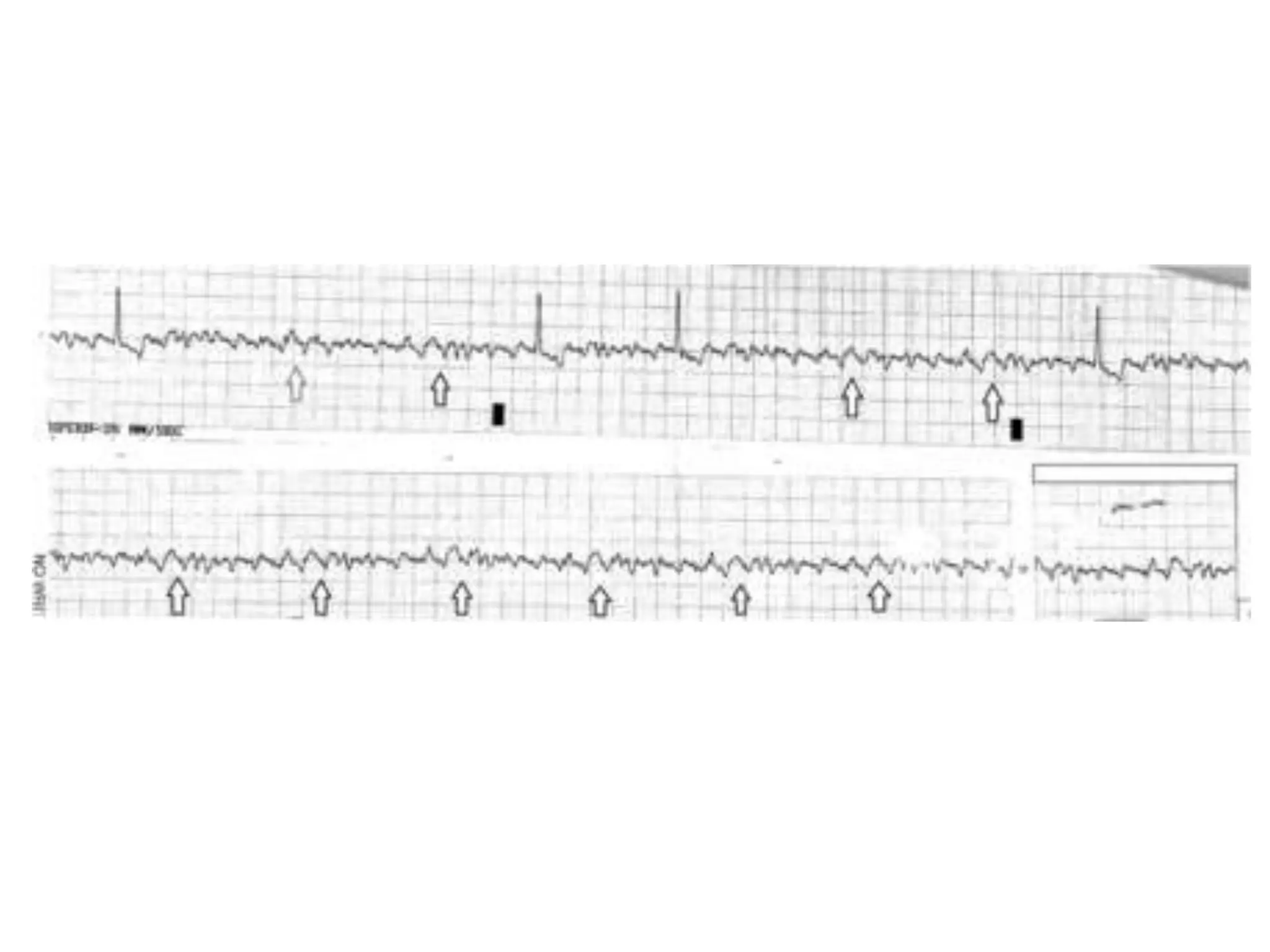 EKG normal.pptx
