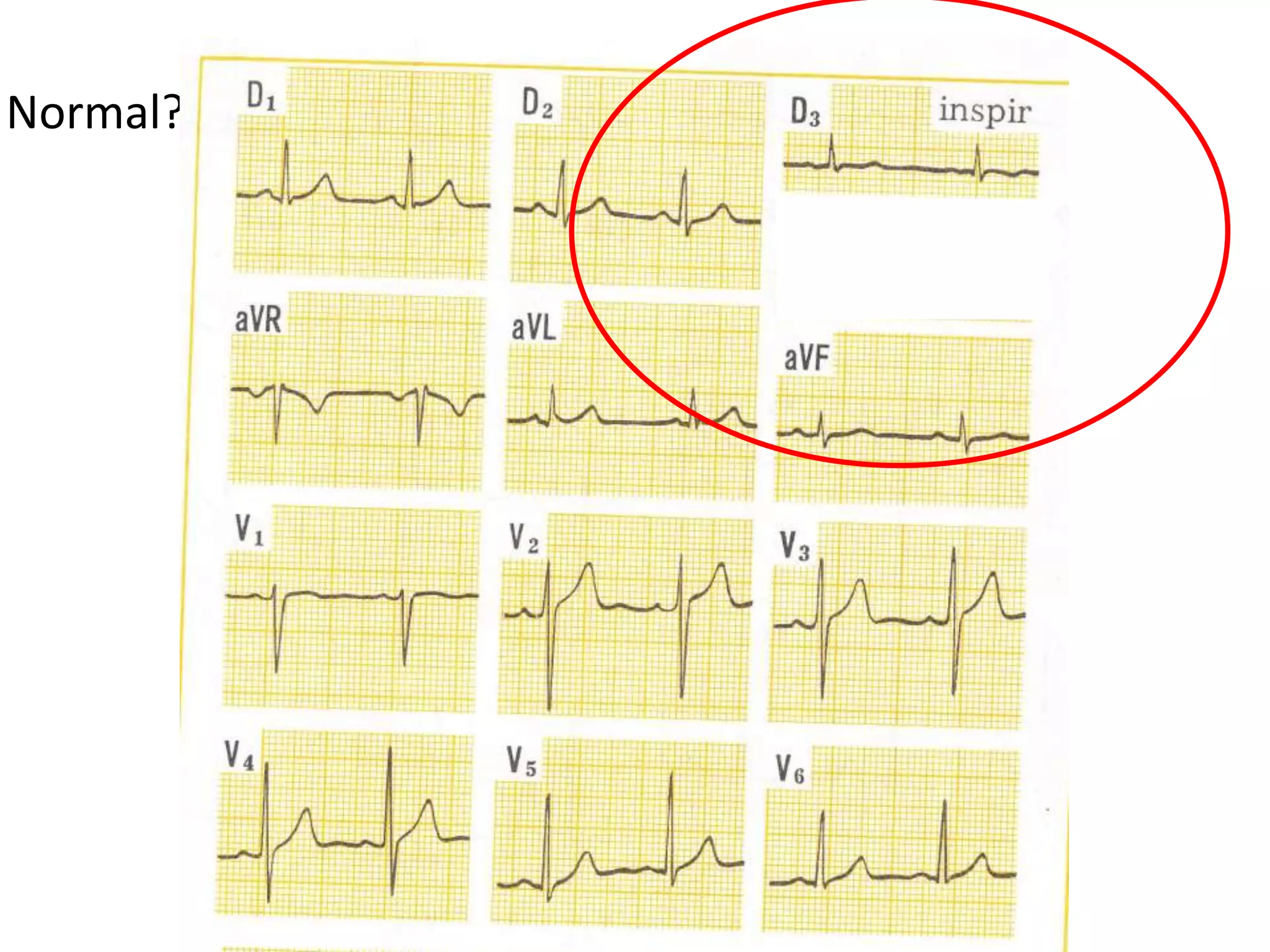 EKG normal.pptx