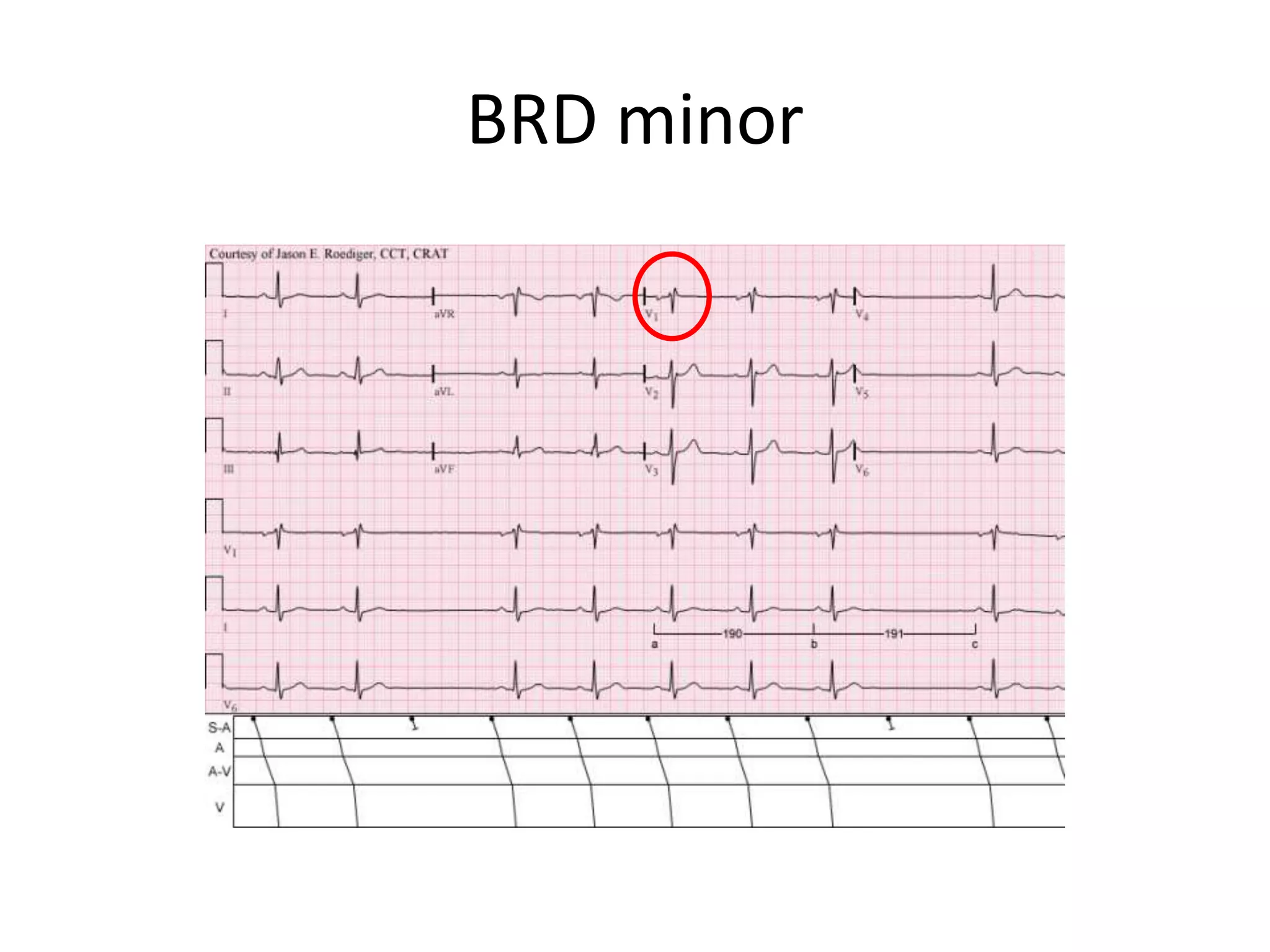 EKG normal.pptx