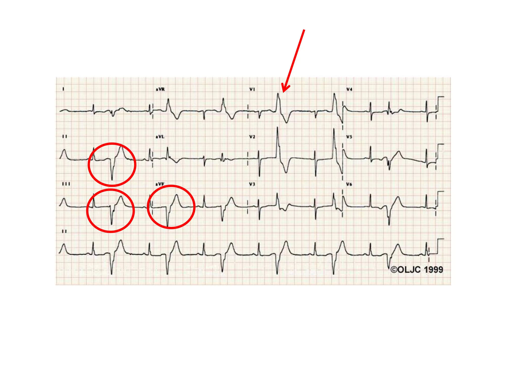 EKG normal.pptx
