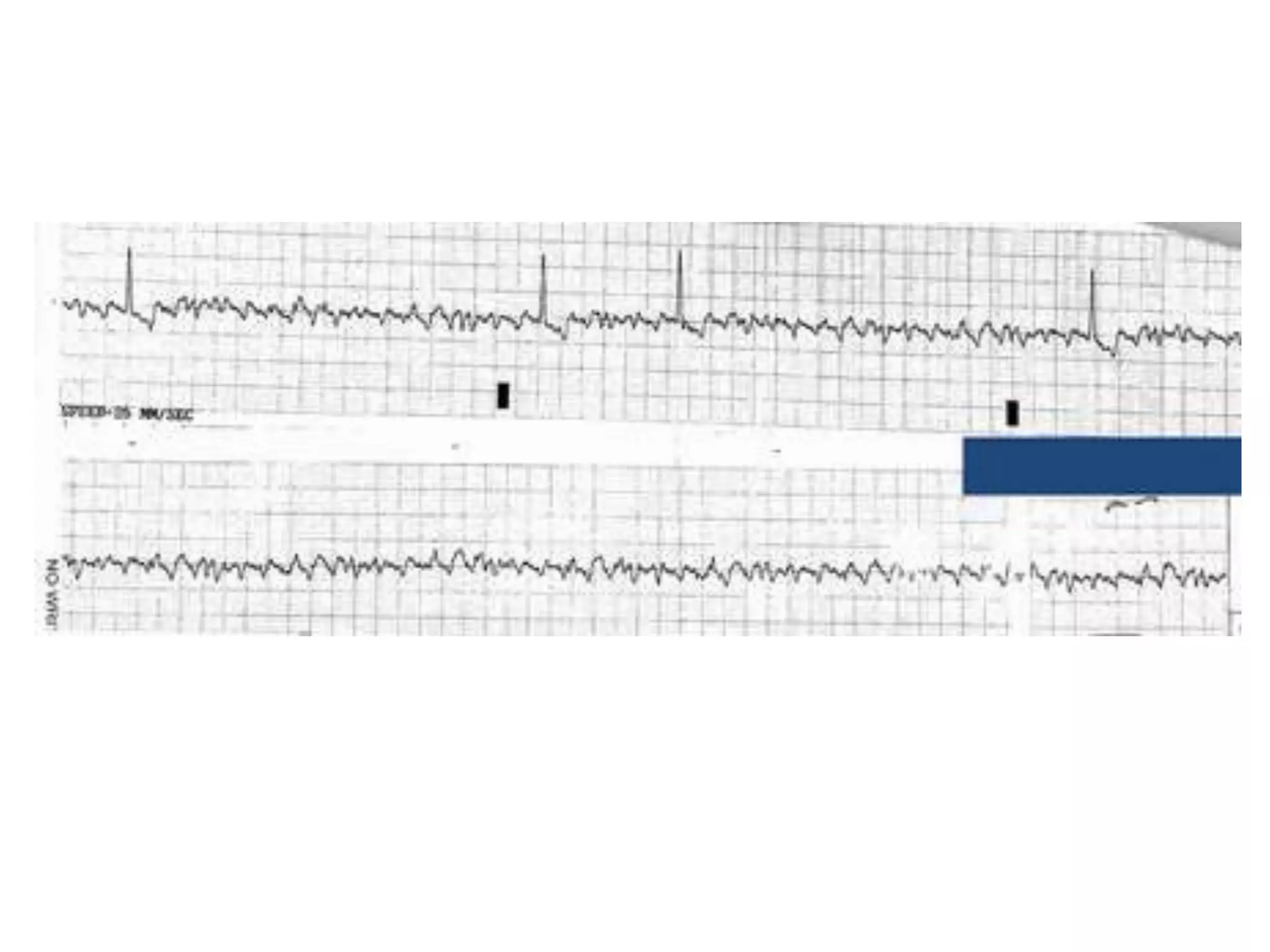 EKG normal.pptx