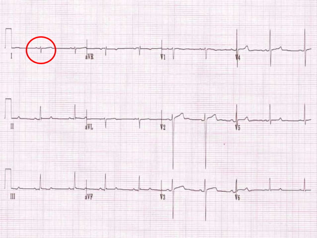 EKG normal.pptx