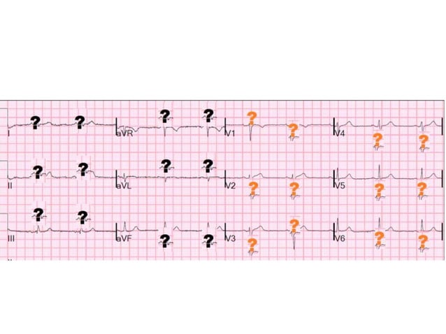EKG normal.pptx
