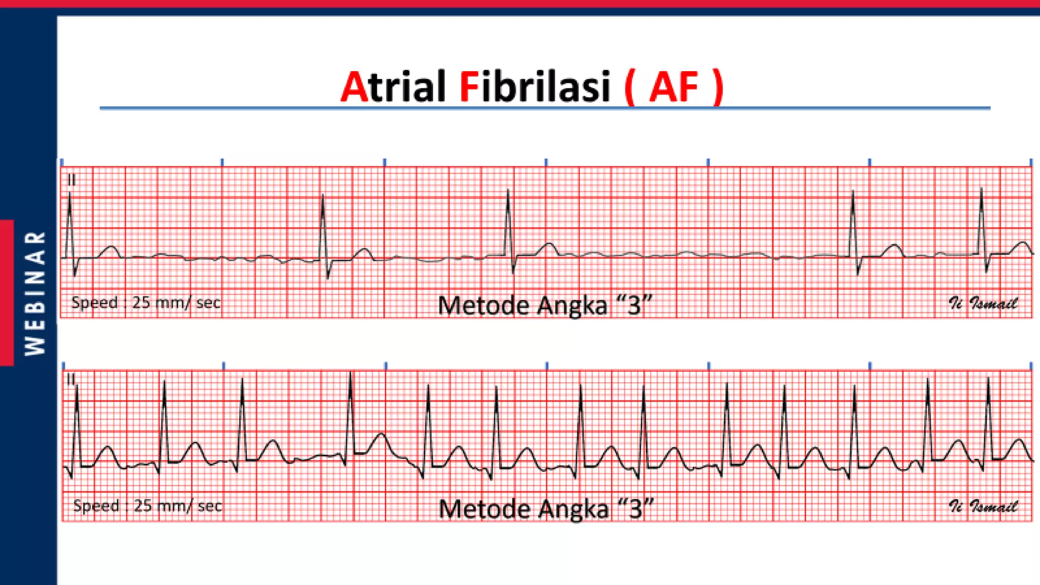 EKG Normal & Aritmia dari II Ismail UNTUK PESERTA .pdf