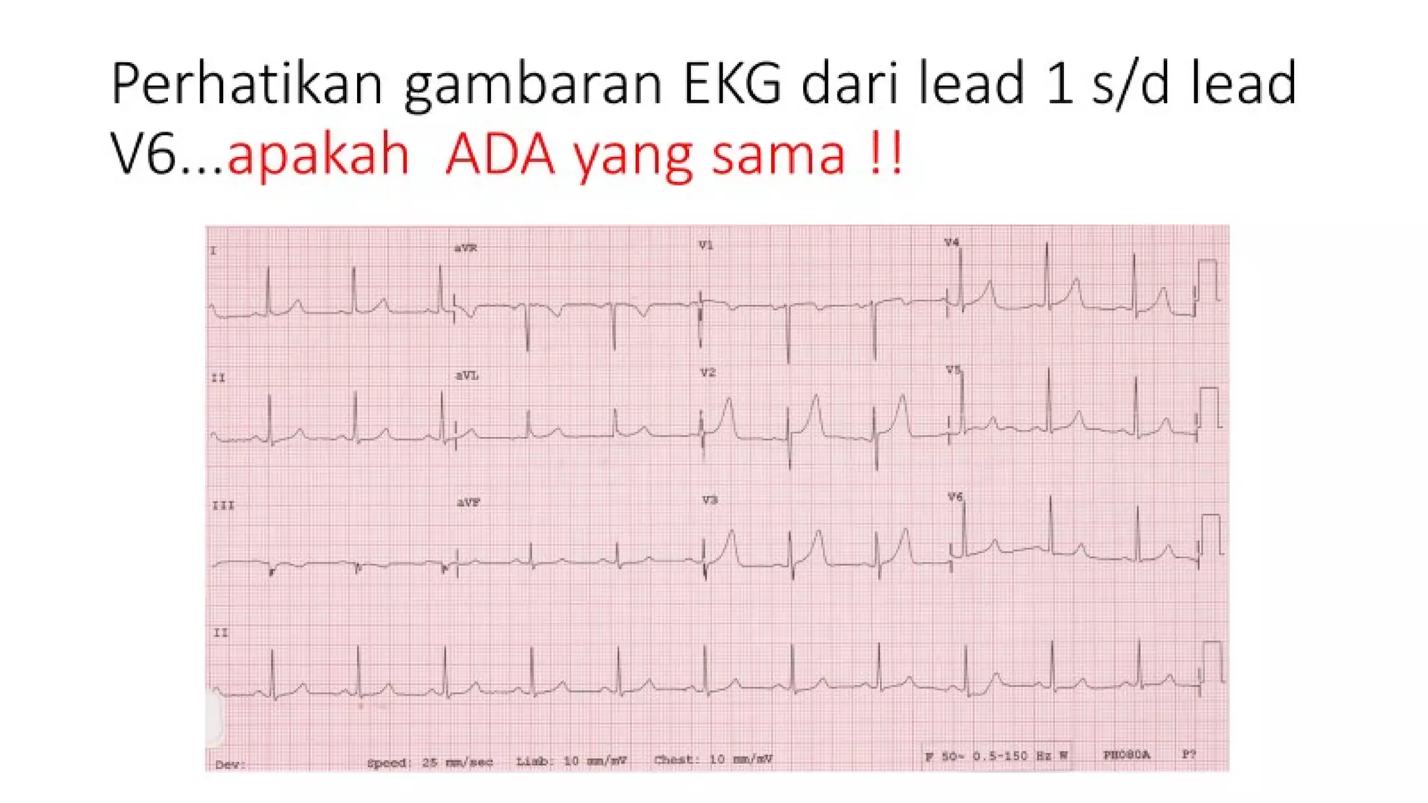 EKG Normal & Aritmia dari II Ismail UNTUK PESERTA .pdf