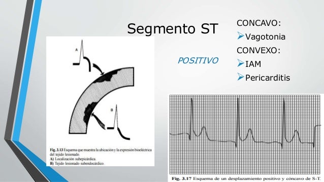 Ekg patologico
