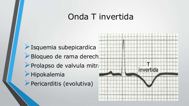 Ekg patologico