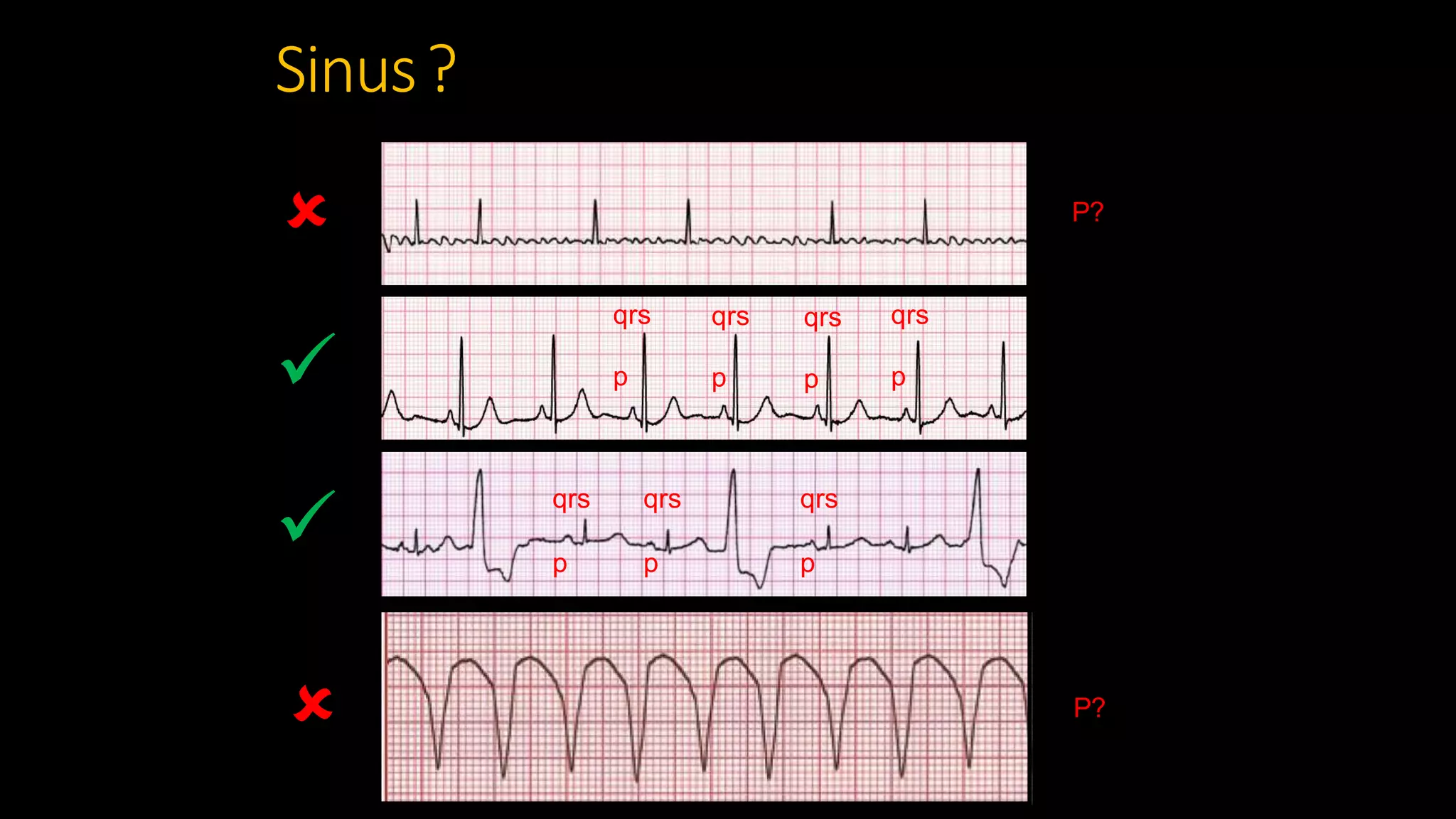 EKG part 1.pptx