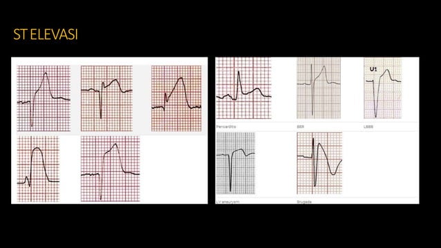 EKG part 1.pptx