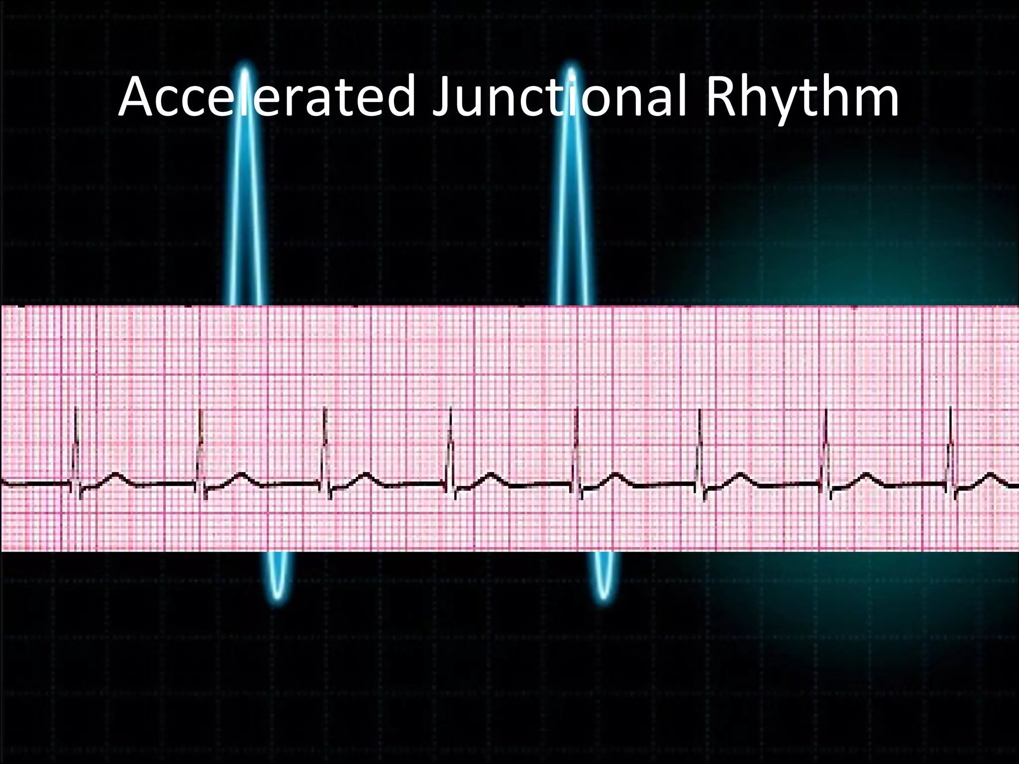 Ekg powerpoint | PPT