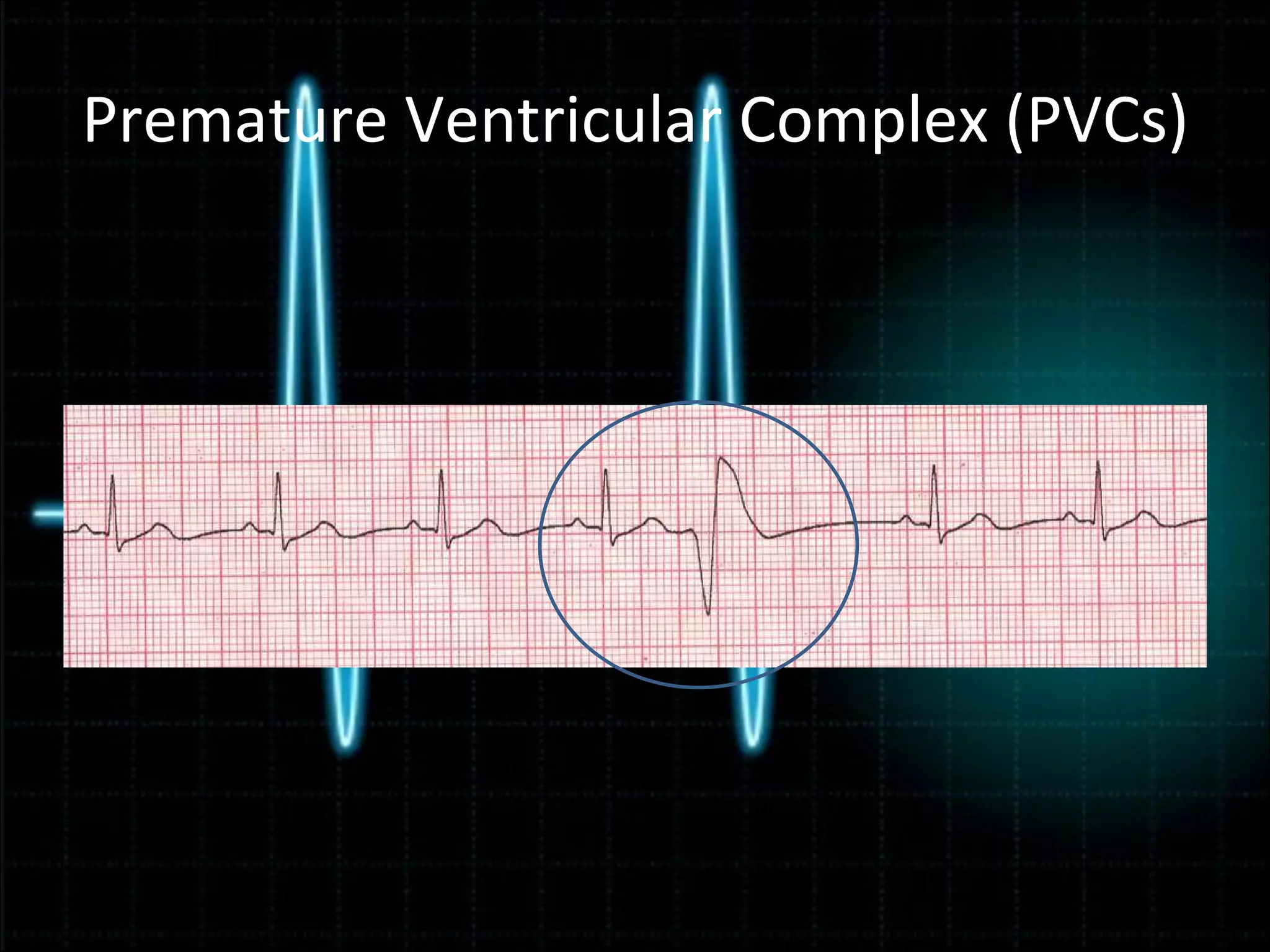 Ekg powerpoint | PPT