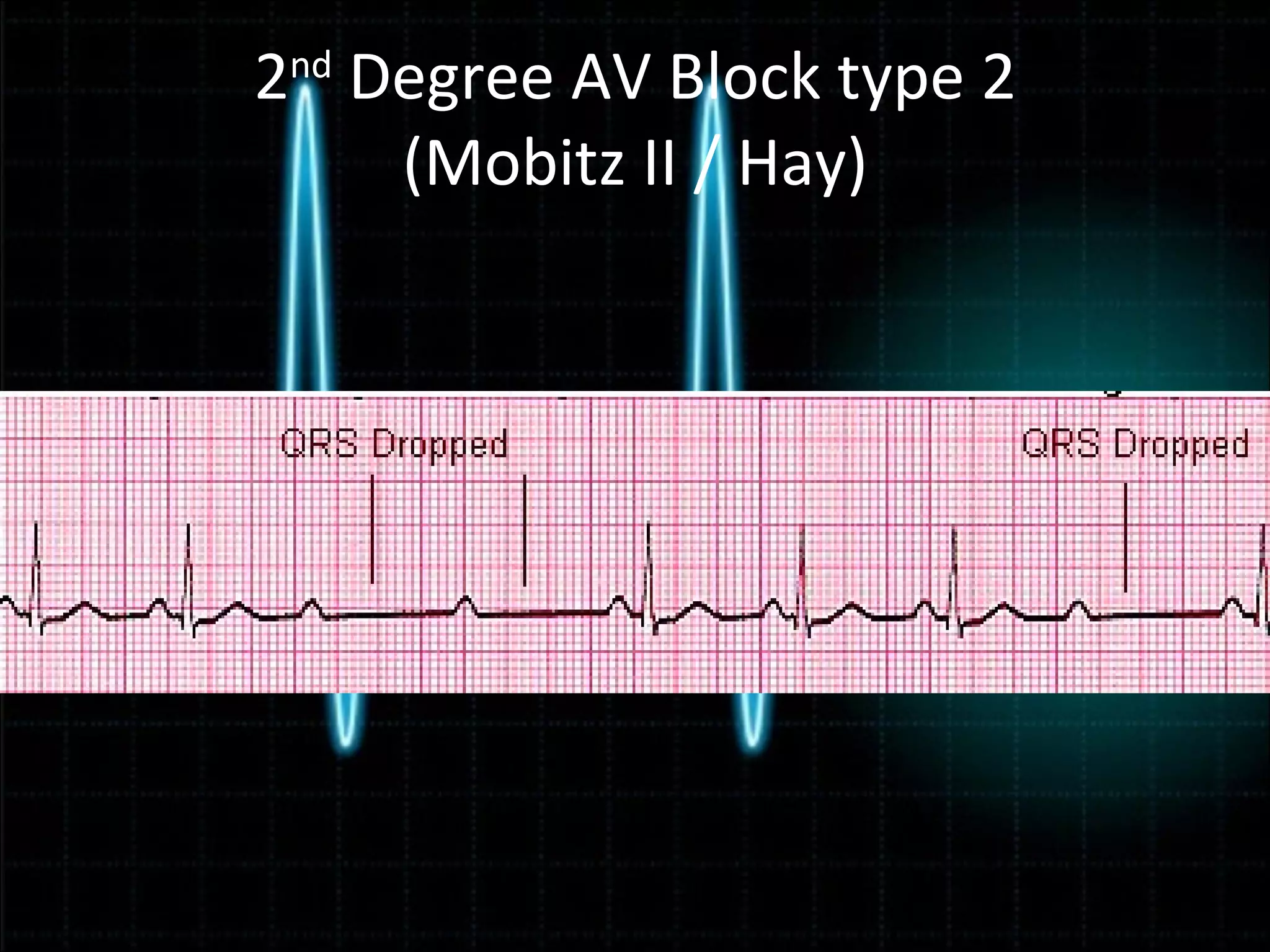 Ekg powerpoint | PPT