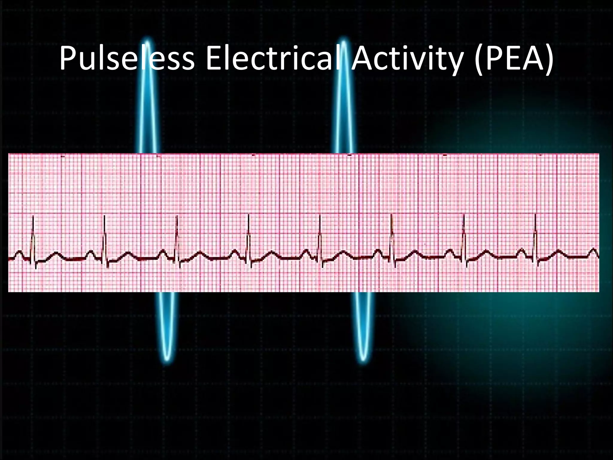 Ekg powerpoint | PPT