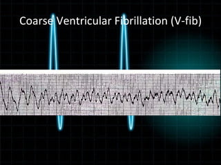 Ekg powerpoint | PPT