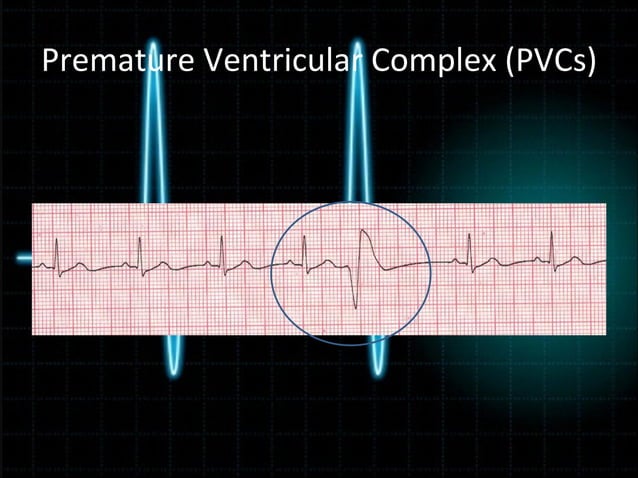 Ekg powerpoint