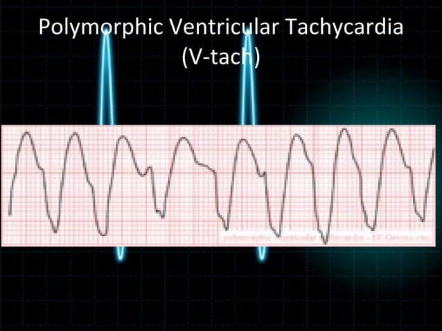 Ekg powerpoint