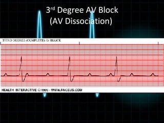 Ekg powerpoint | PPT