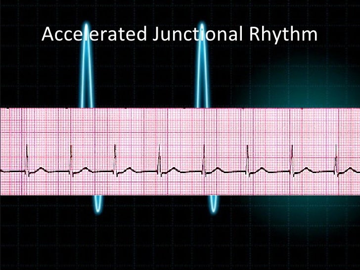 Junctional Escape Rhythm Strip