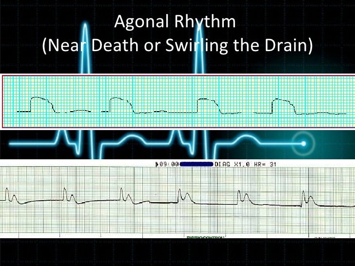 Ekg powerpoint