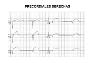 Electrocardiograma De Infarto De Miocardio Lateral