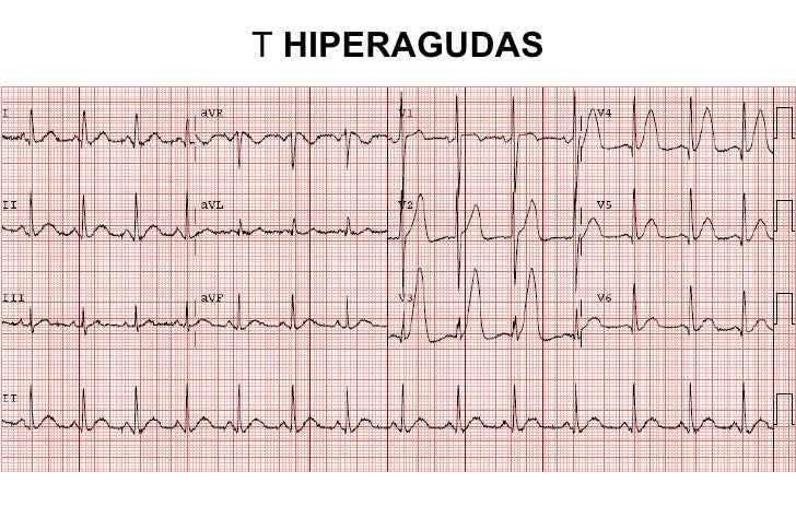 Electrocardiograma Ecg En Infarto De Miocardio Iam