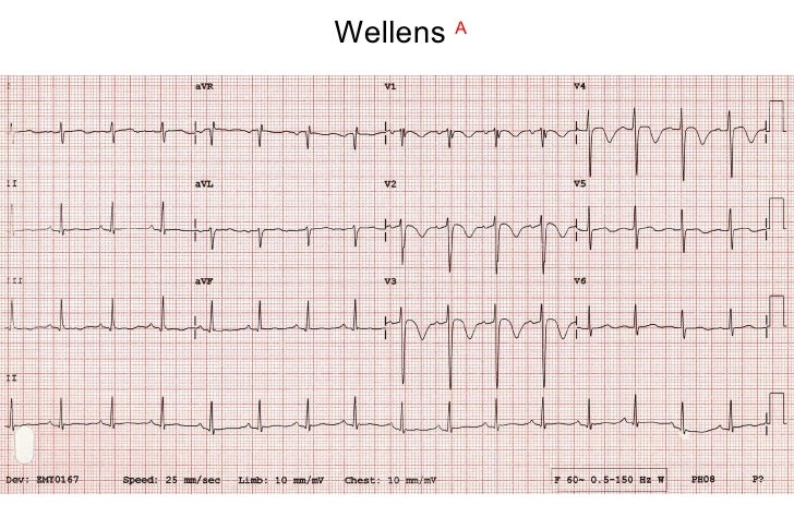 Electrocardiograma Ecg En Infarto De Miocardio Iam