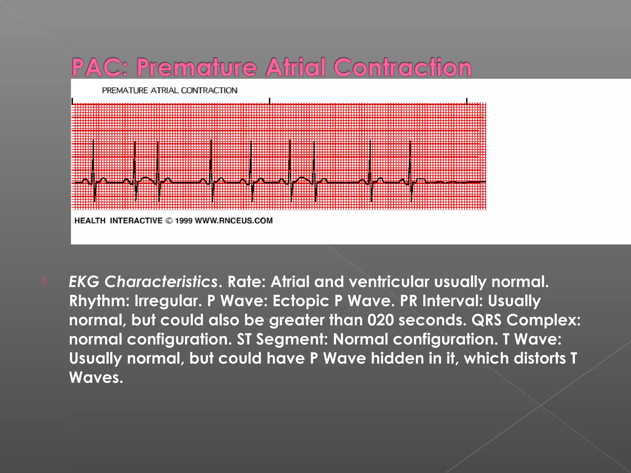 Ekg presentation | PPT