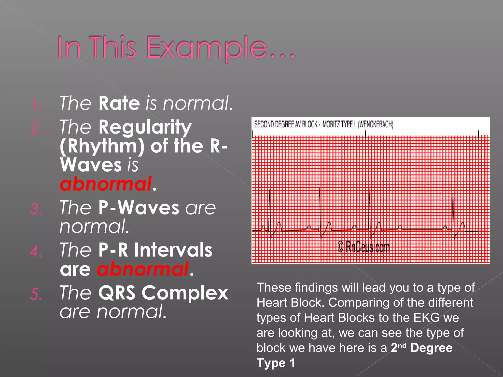 Ekg presentation | PPT