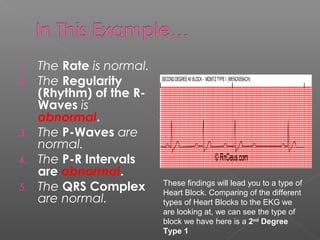 Ekg presentation | PPT