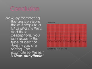 Ekg presentation | PPT