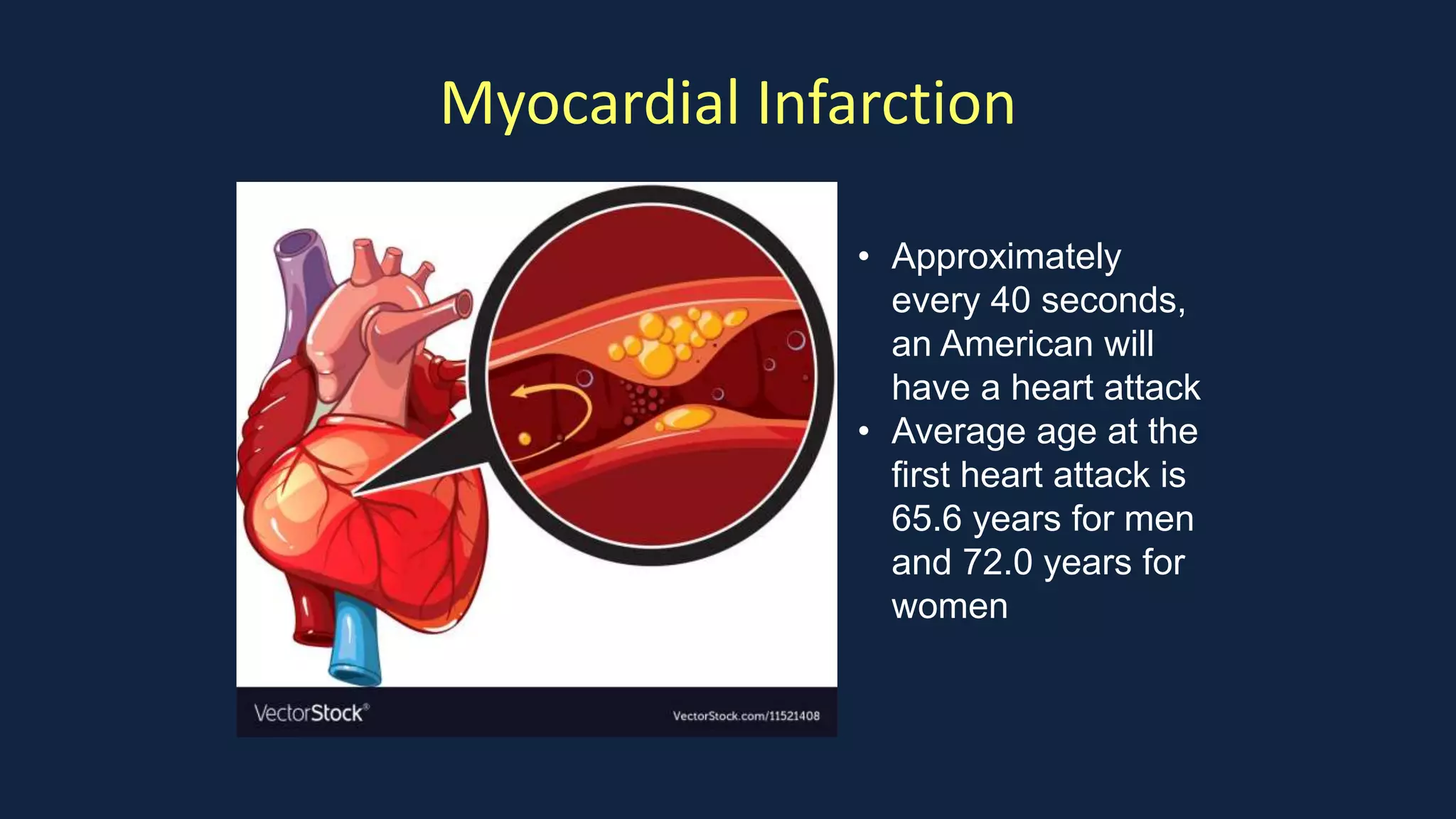 Using EKG to Confirm MI in Mouse Model of Permanent LAD Occlusion | PPTX
