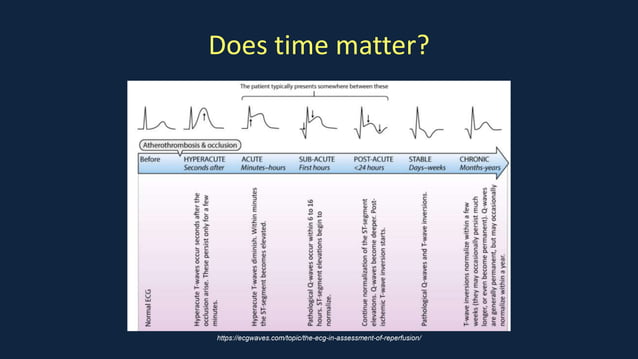 Using EKG to Confirm MI in Mouse Model of Permanent LAD Occlusion | PPTX