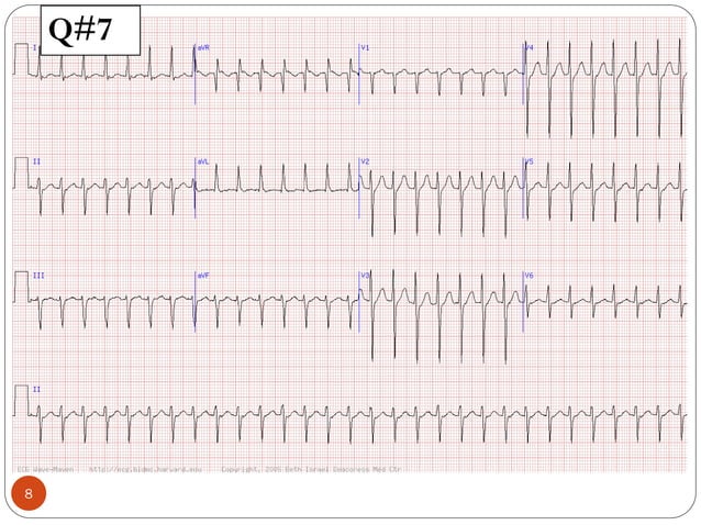 Ekg quiz 2 | PDF