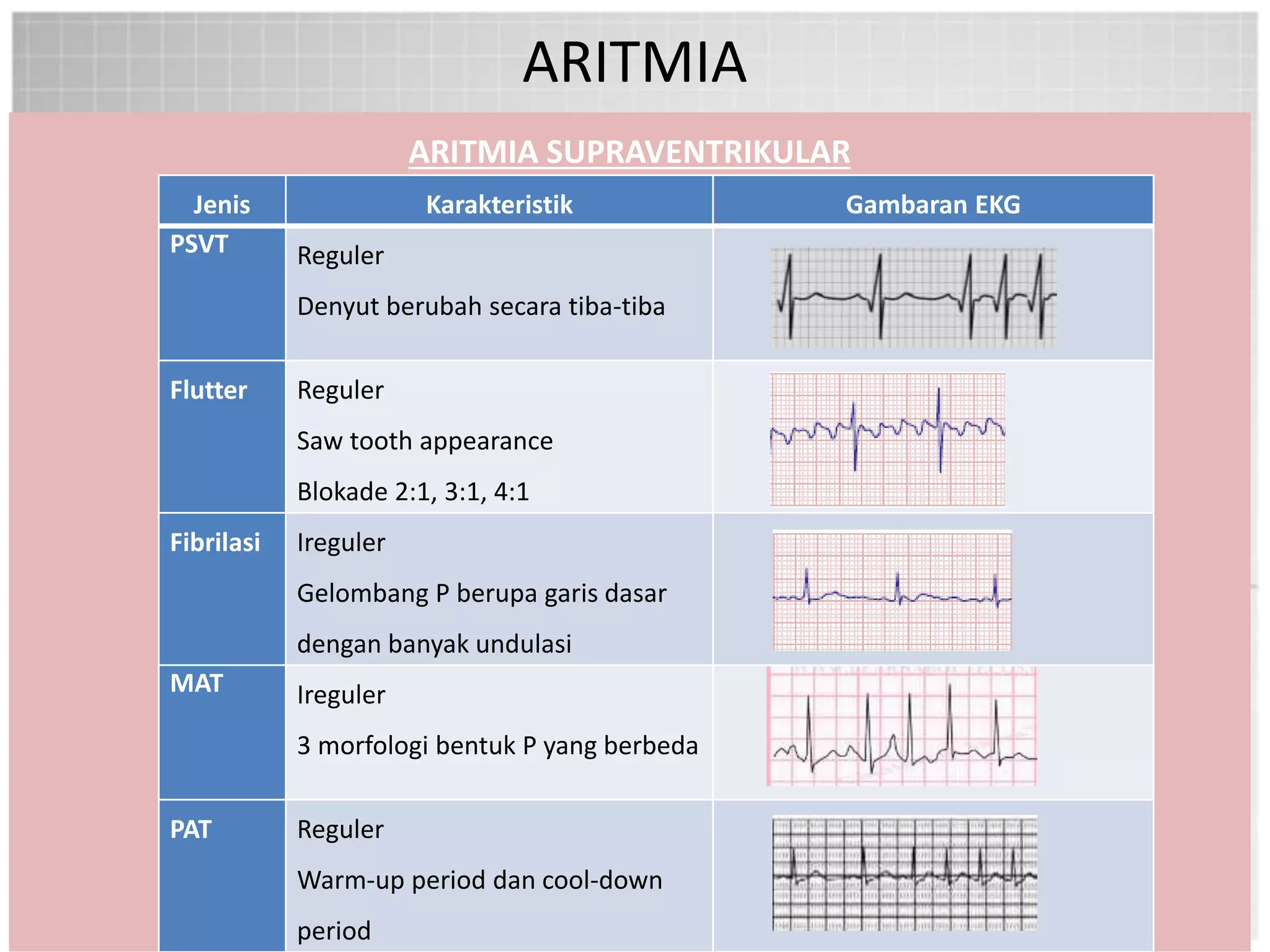 EKG REFERAT ELISA.ppt