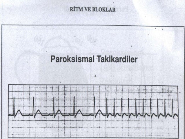 Ekg, ritim ve pace maker | PPT