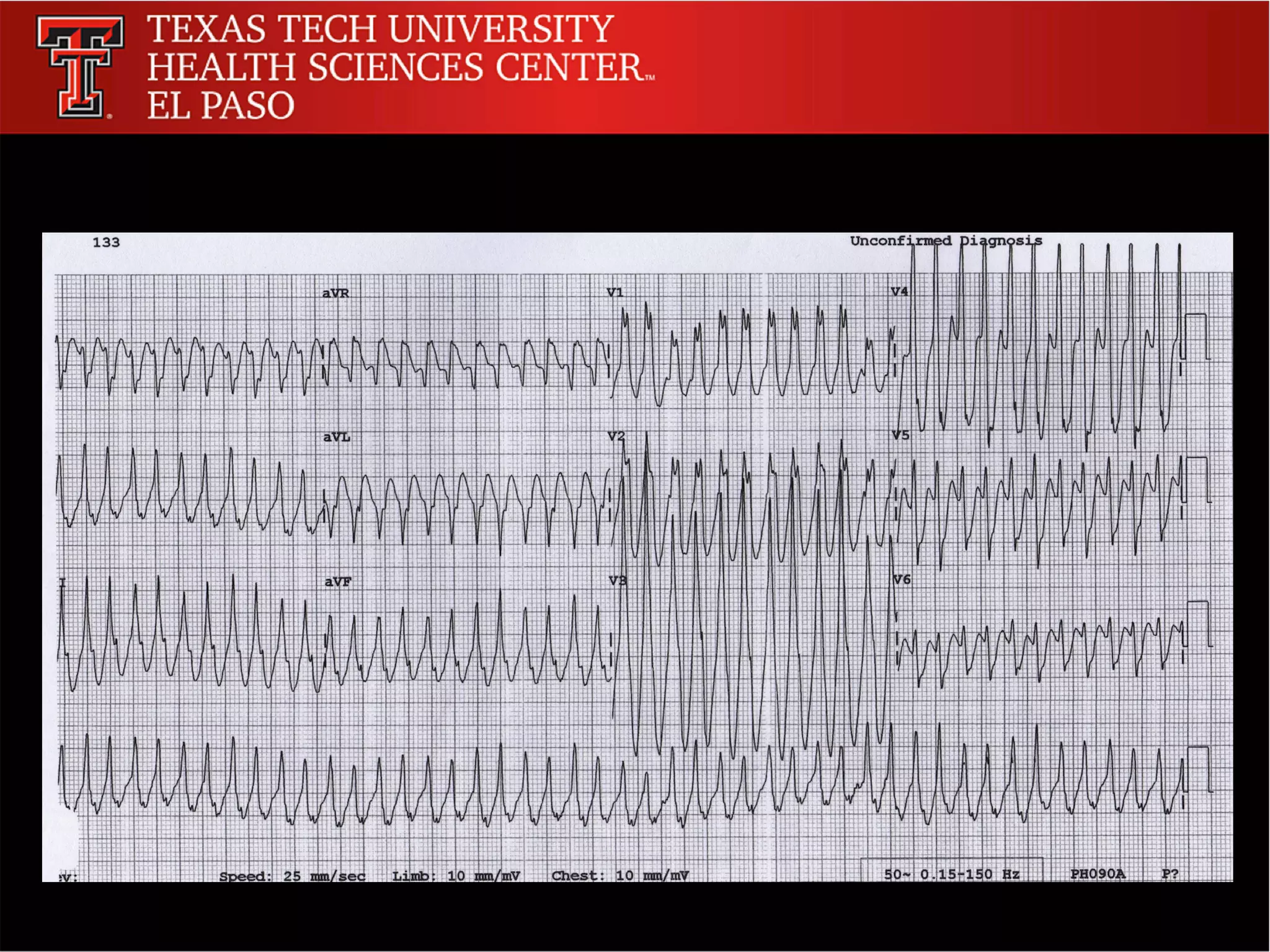 EKG Patterns of SCD - Can't Miss EKG Patterns for Generalist ...