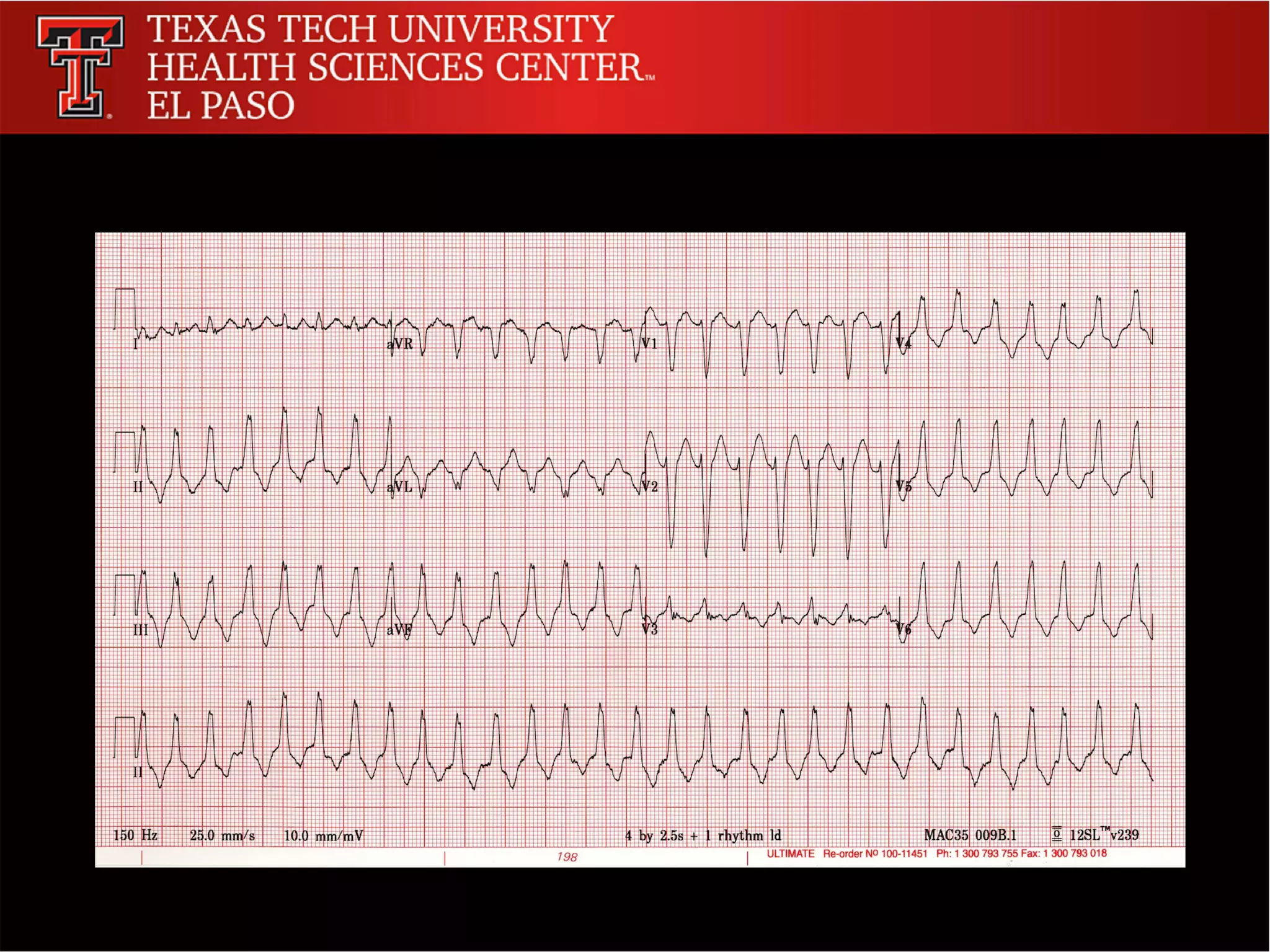 EKG Patterns of SCD - Can't Miss EKG Patterns for Generalist ...