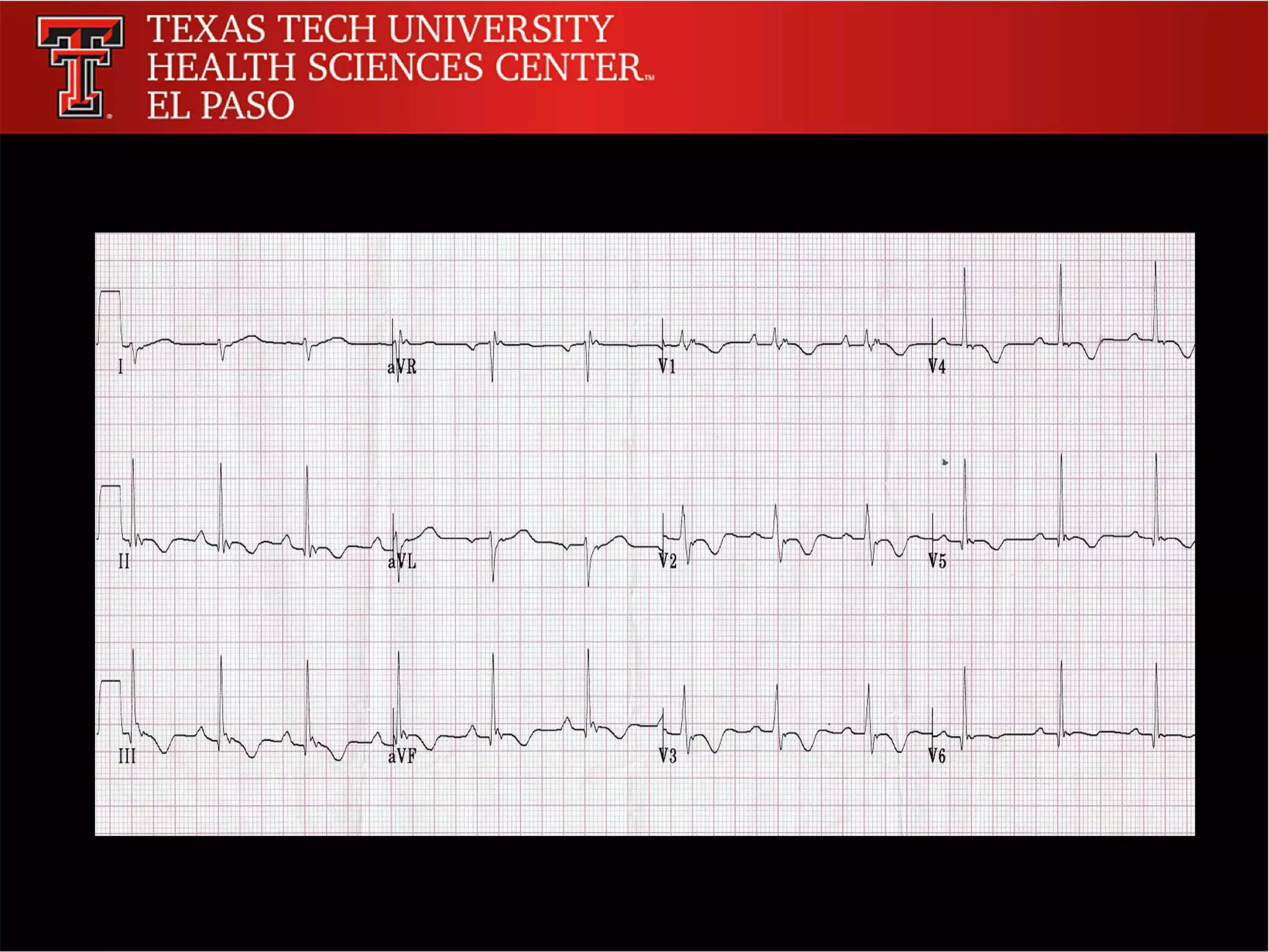 EKG Patterns of SCD - Can't Miss EKG Patterns for Generalist ...