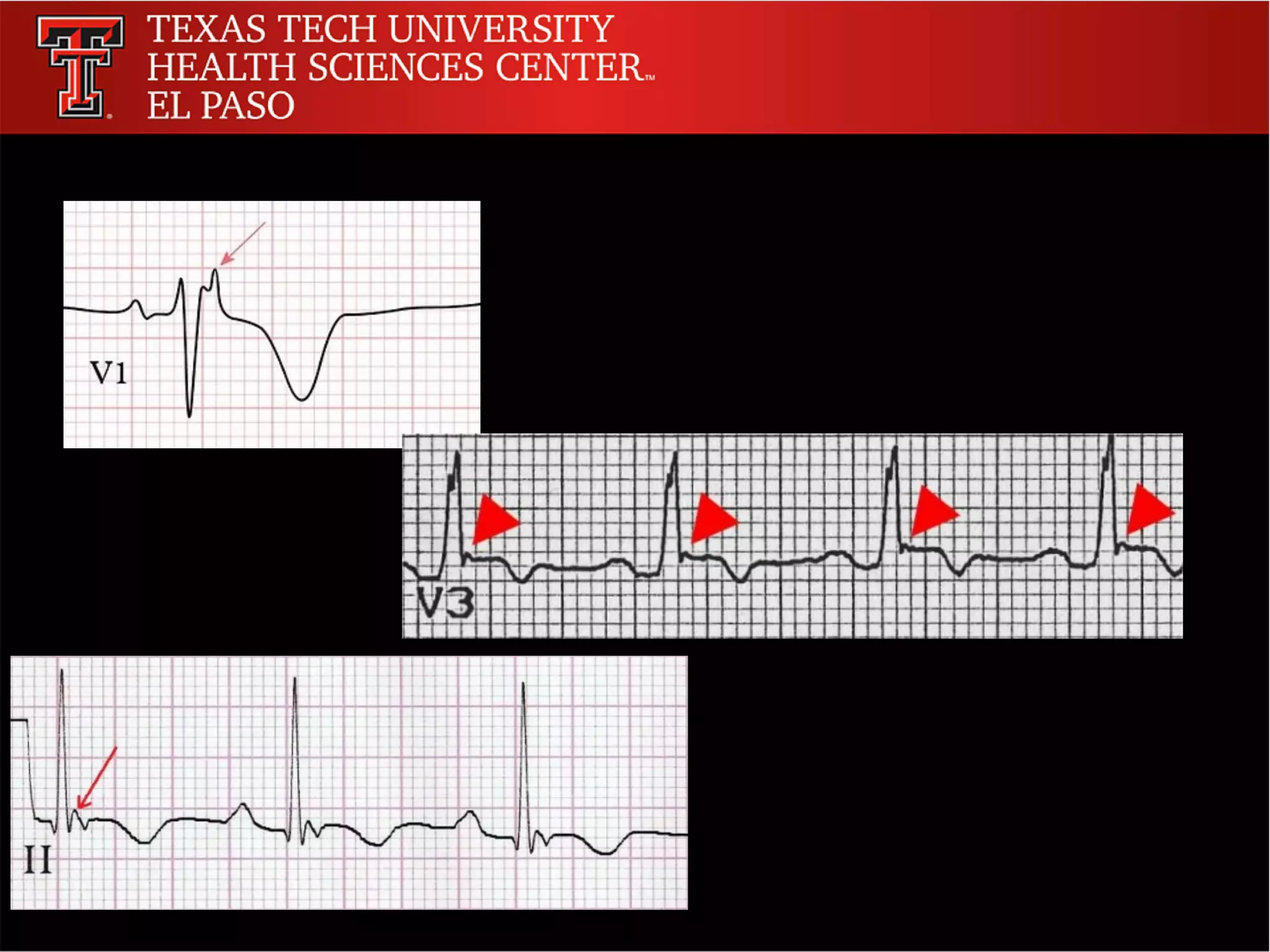 EKG Patterns of SCD - Can't Miss EKG Patterns for Generalist ...