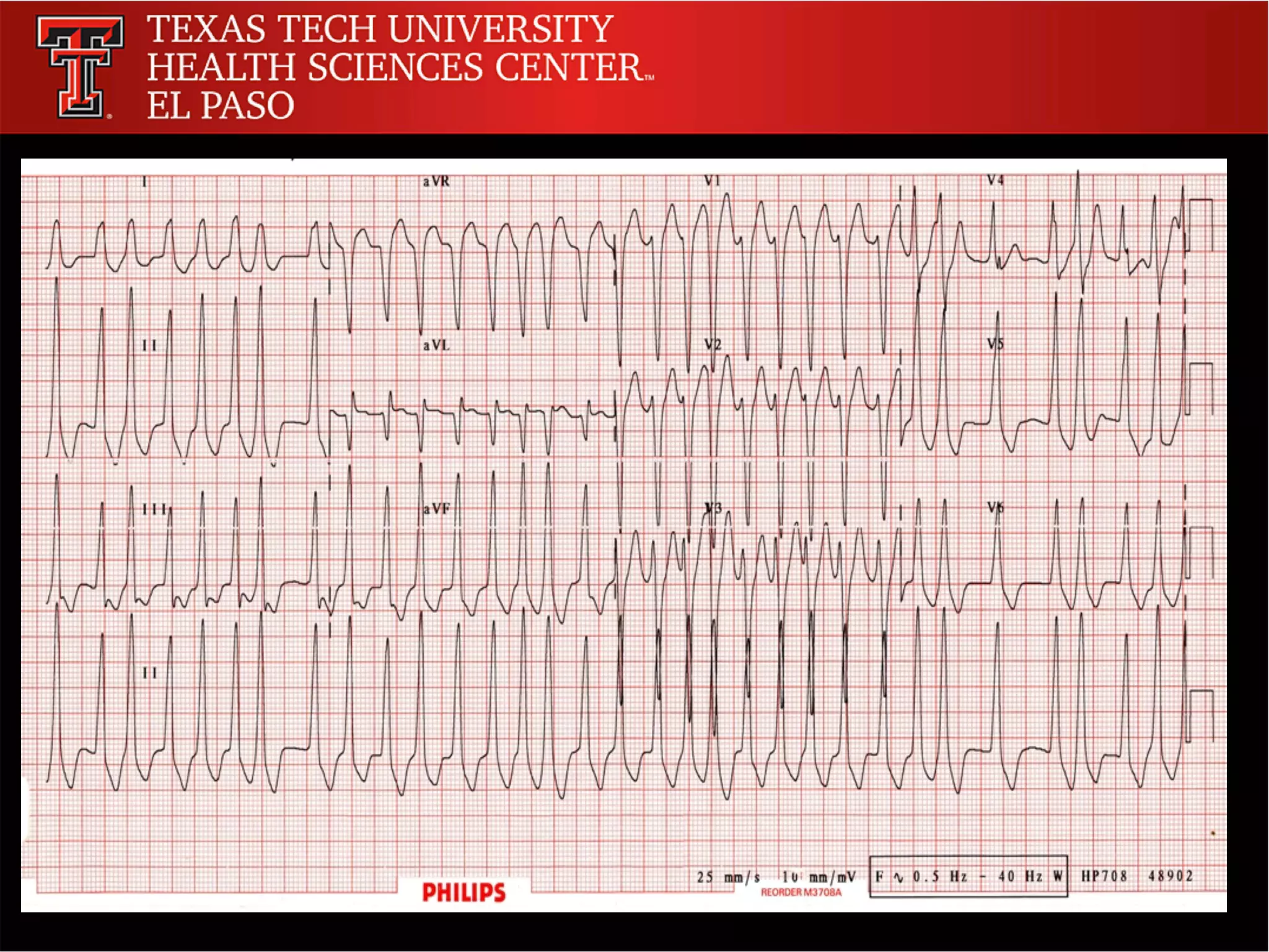 EKG Patterns of SCD - Can't Miss EKG Patterns for Generalist ...