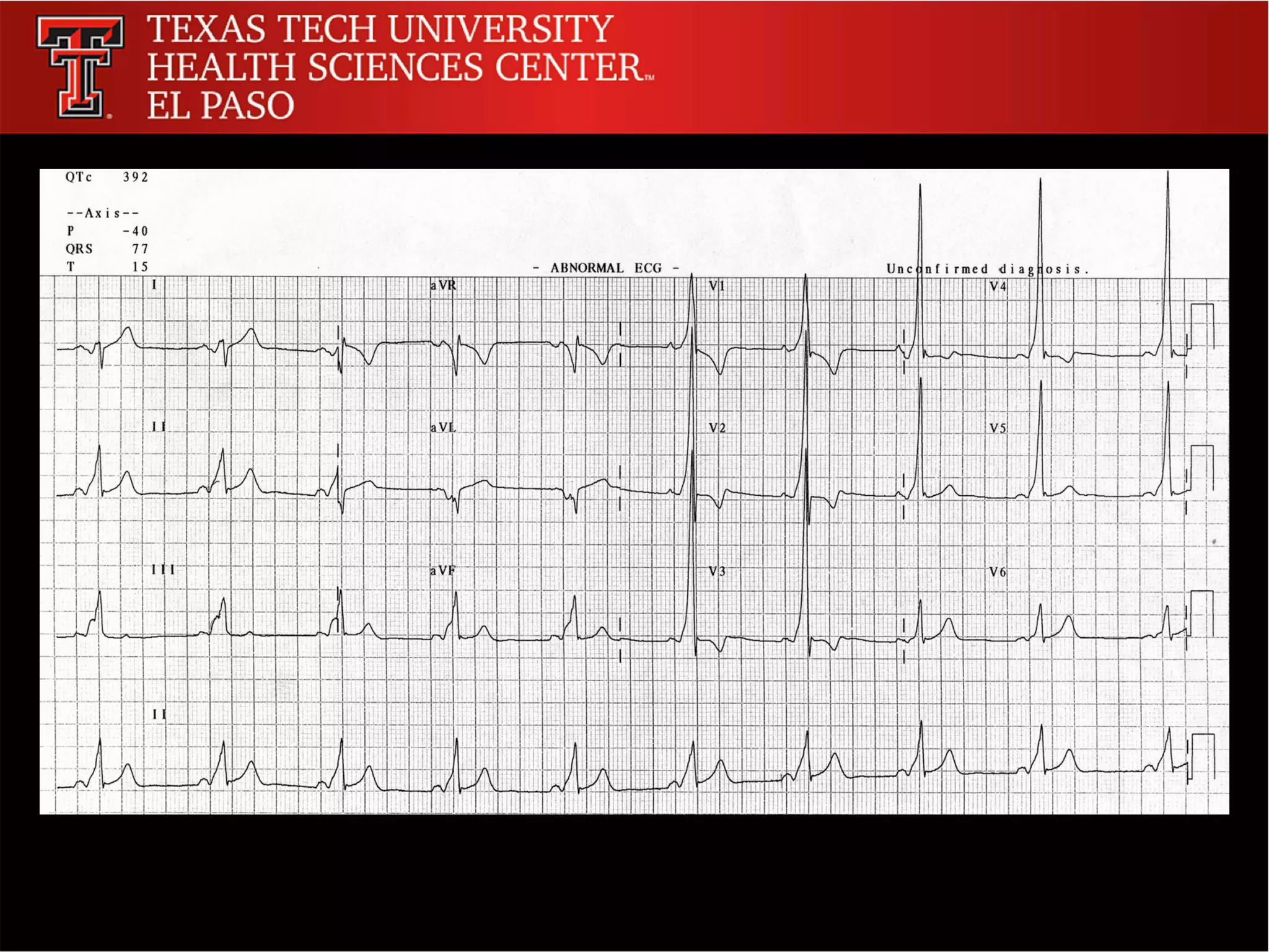 EKG Patterns of SCD - Can't Miss EKG Patterns for Generalist ...